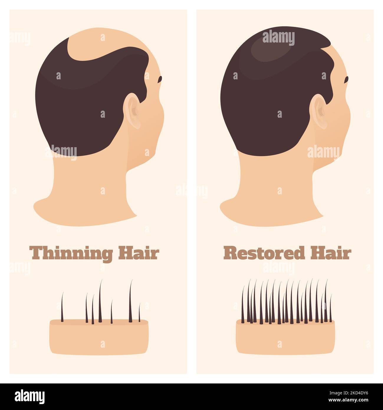 Alopecia in men, conceptual illustration Stock Photo - Alamy Alopecia in men, conceptual illustration Stock Photo - Alamy