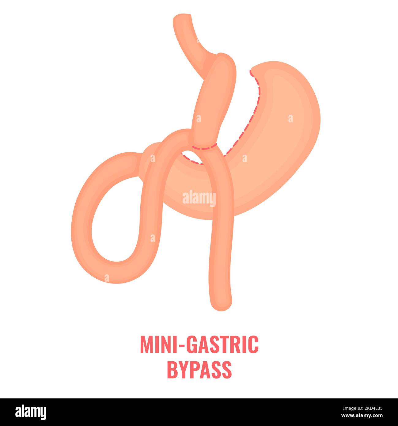 Mini gastric bypass bariatric surgery, illustration Stock Photo - Alamy