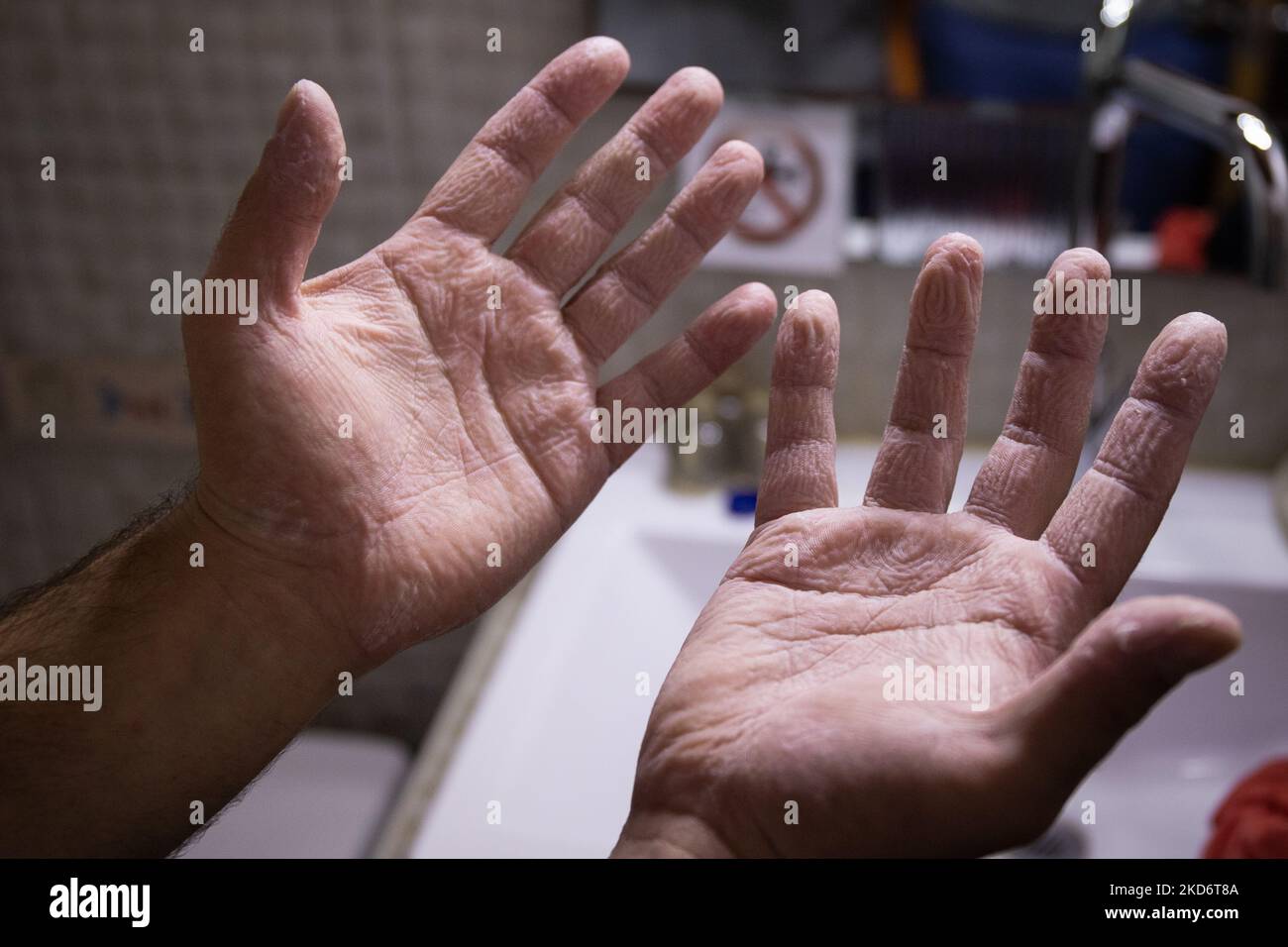 A closeup of wrinkled hands after being wet for too long Stock Photo ...