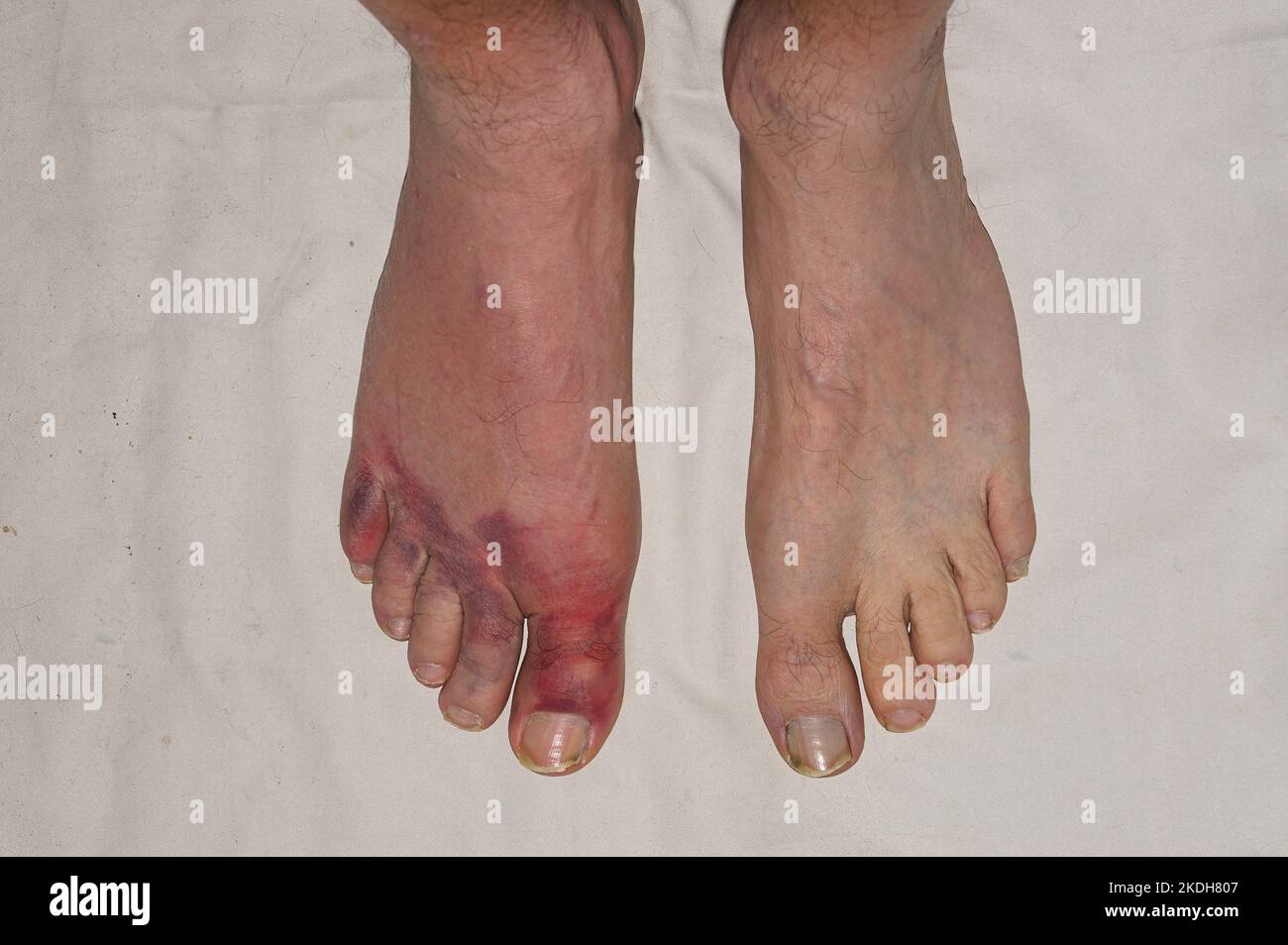 Injured and bruised toes on a man's right foot compared to an uninjured ...