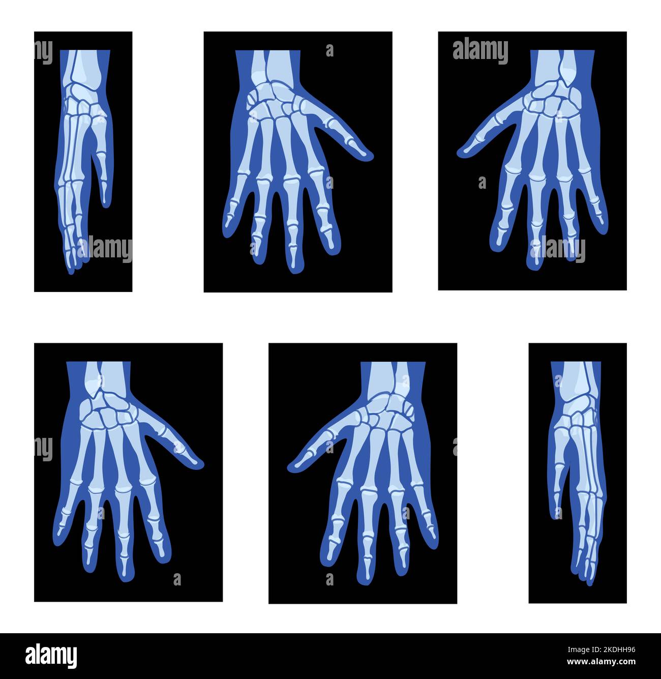 Set of X-Ray Hands Skeleton Human body, Bones adult people roentgen ...