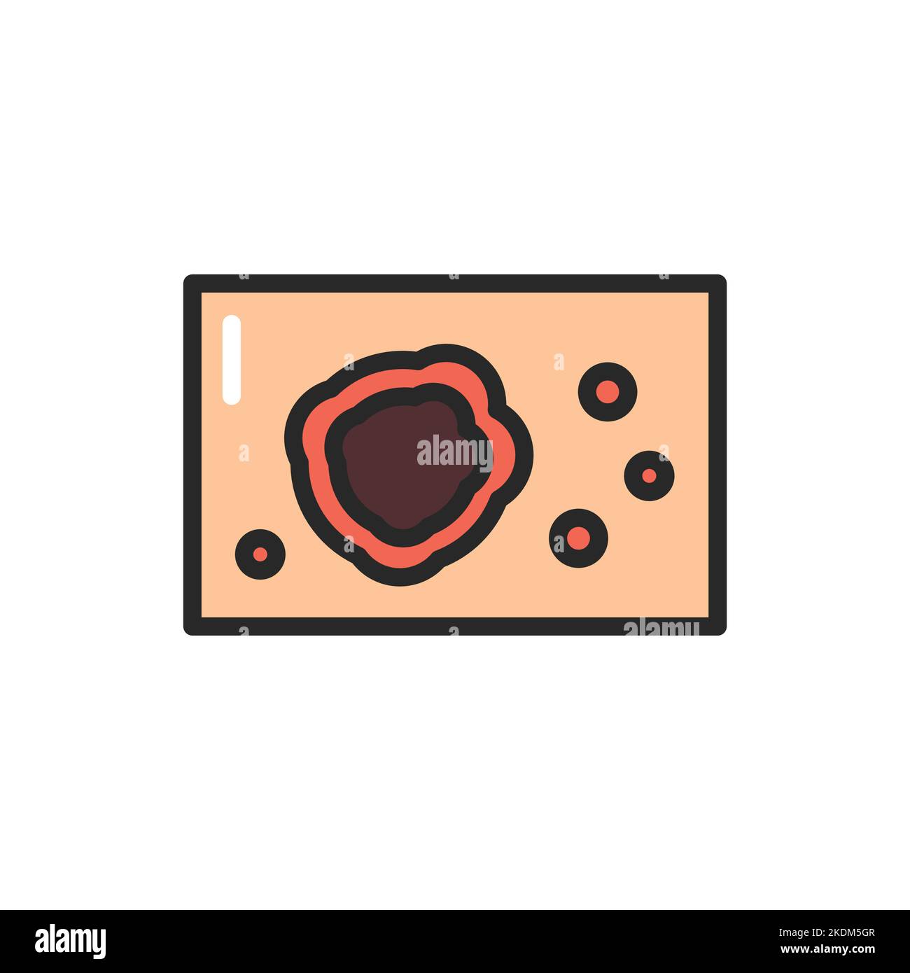 Nodular melanoma Stock Vector Images - Alamy