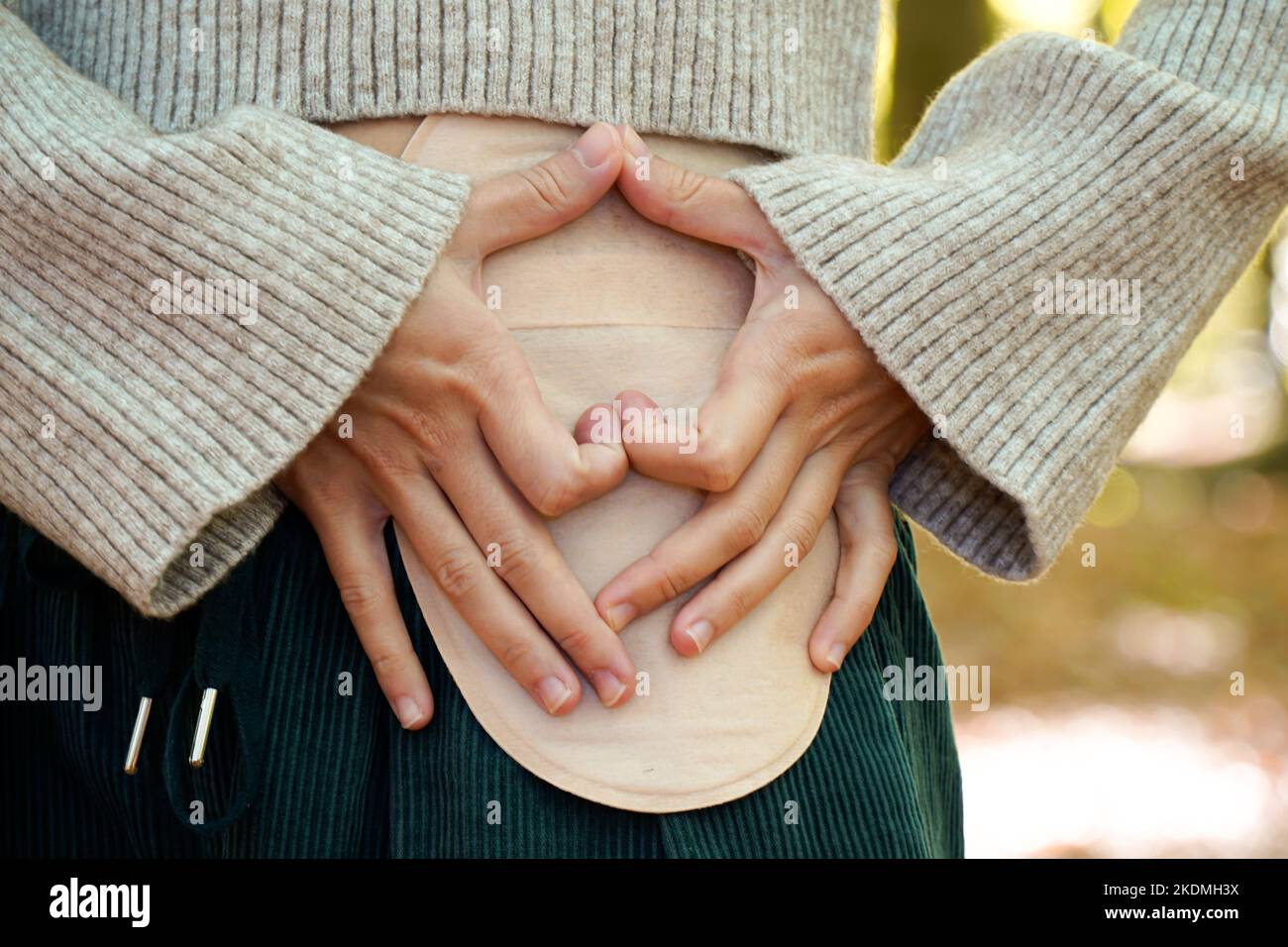 heart-shaped hands on a woman's ostomy in the forest. colostomy bag for ...