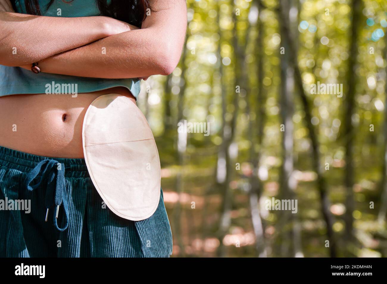 woman's body with an ostomy bag on her belly in a beech forest Stock ...