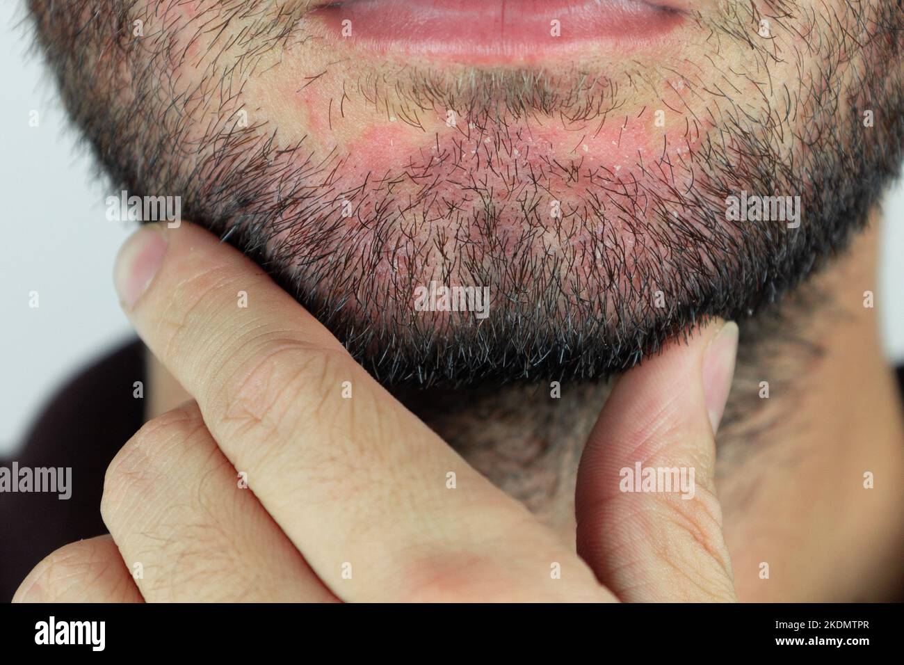 Seborrheic dermatitis in the beard. Eczema on male face close up Stock ...