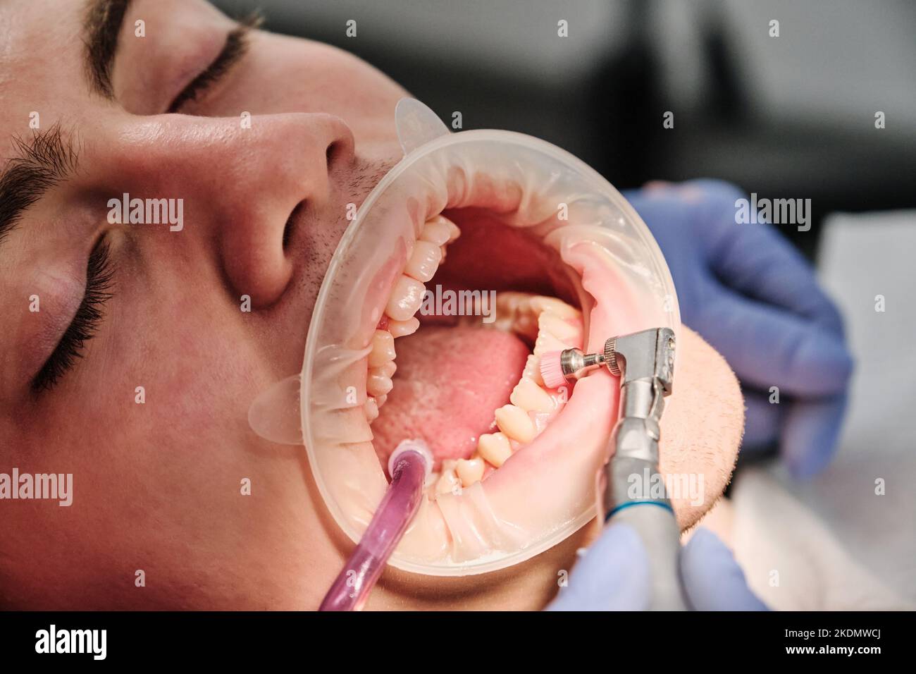 Process of using stomatological brush as a stage of professional dental ...