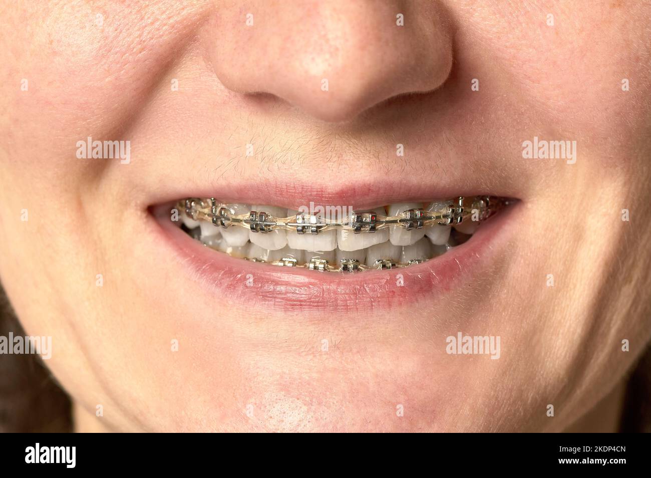 a woman's smile with open teeth on which there are braces Stock Photo ...
