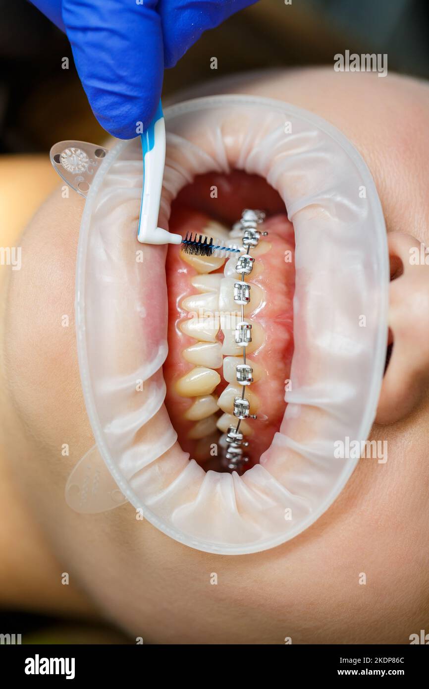 Installation of braces on teeth. Orthodontic dental treatment. Close-up ...