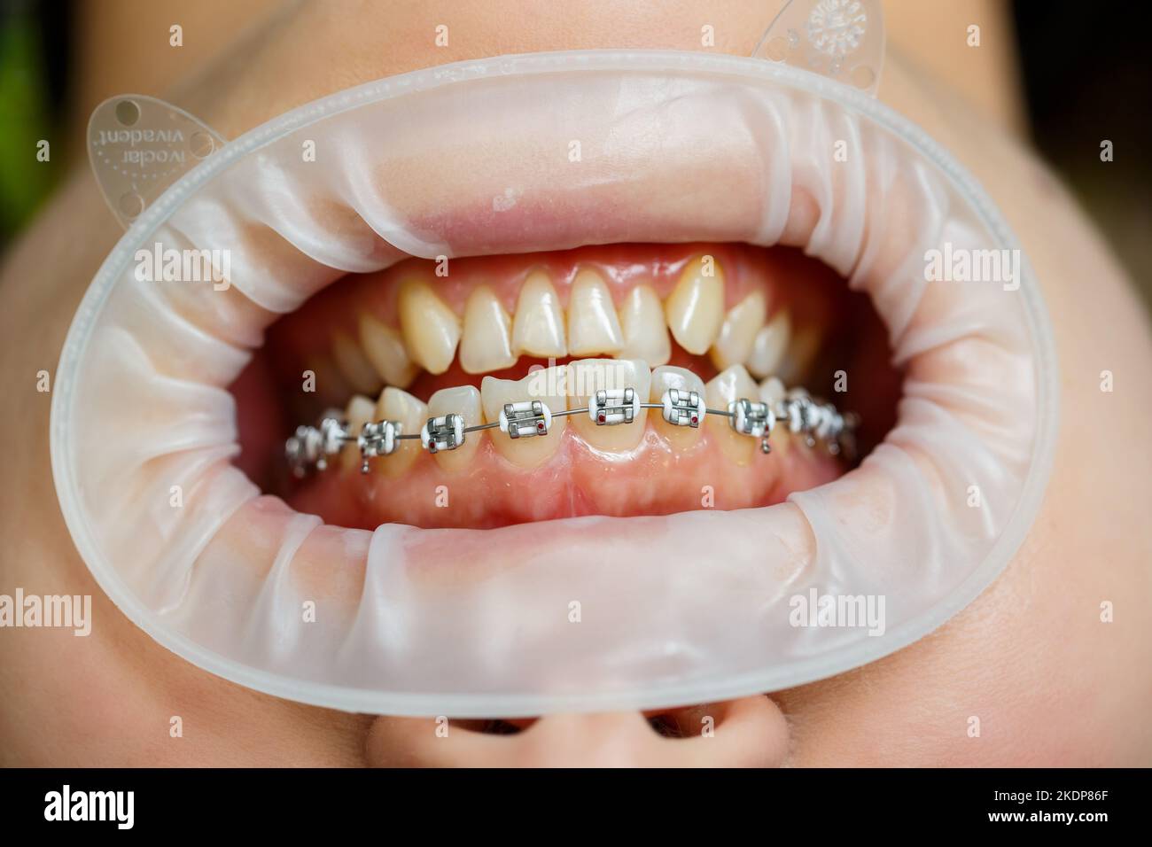 Installation of braces on teeth. Orthodontic dental treatment. Close-up of teeth with braces ...