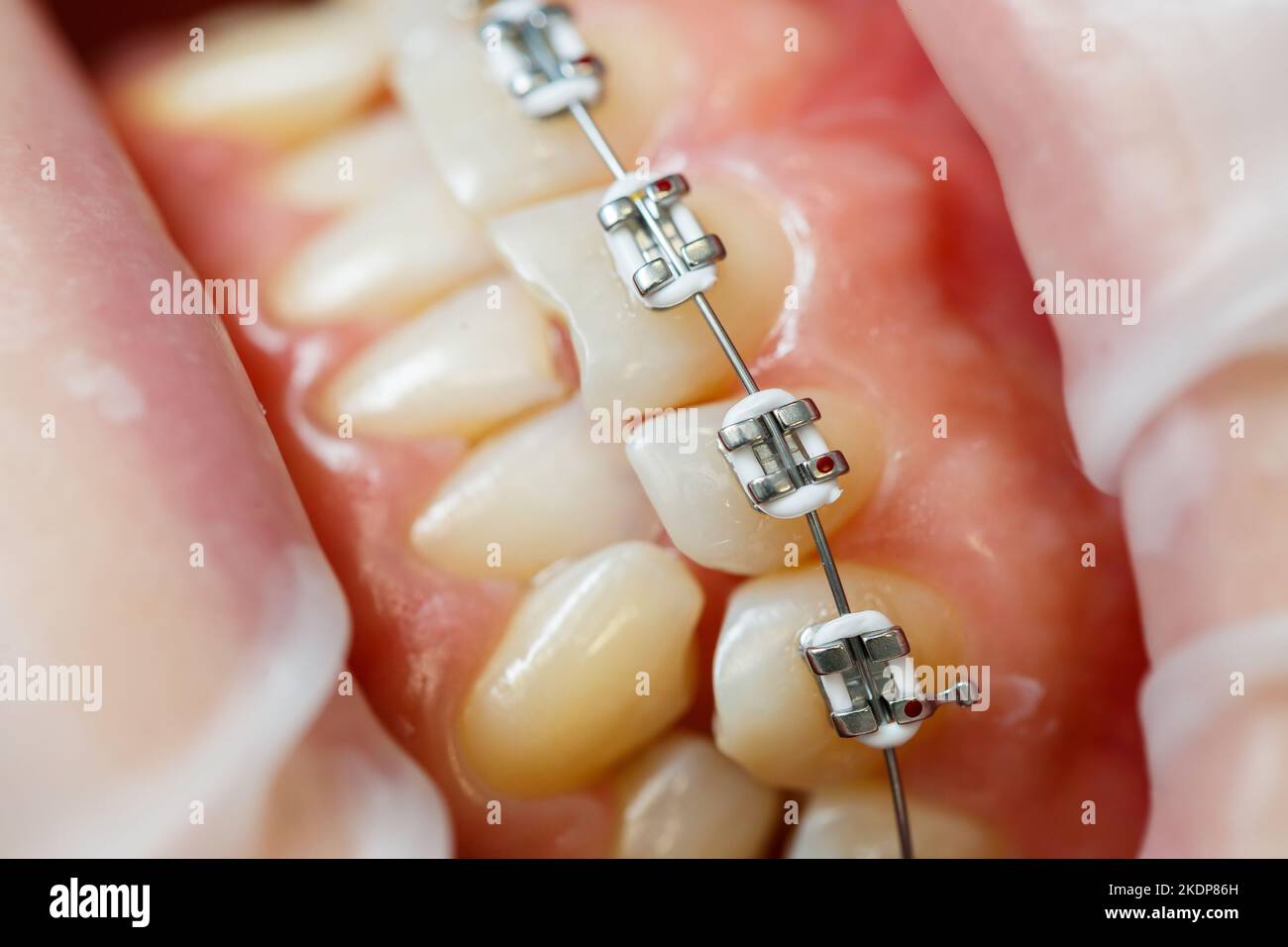 Installation of braces on teeth. Orthodontic dental treatment. Close-up ...
