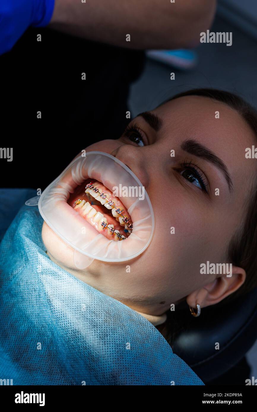 Extender for teeth. Teeth of a woman with braces at a dentist ...