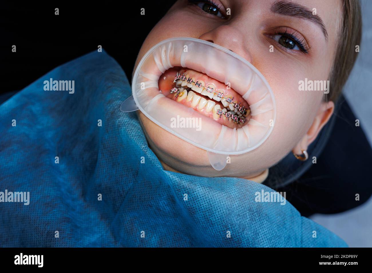Extender for teeth. Teeth of a woman with braces at a dentist ...