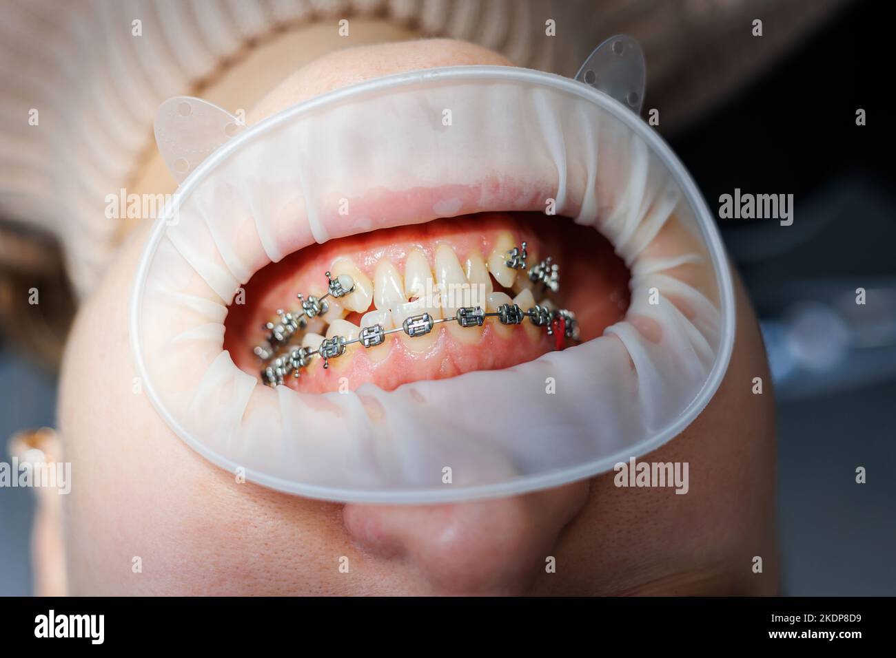 Close-up of mouth and teeth with metal braces. Orthodontic dental treatment Stock Photo - Alamy