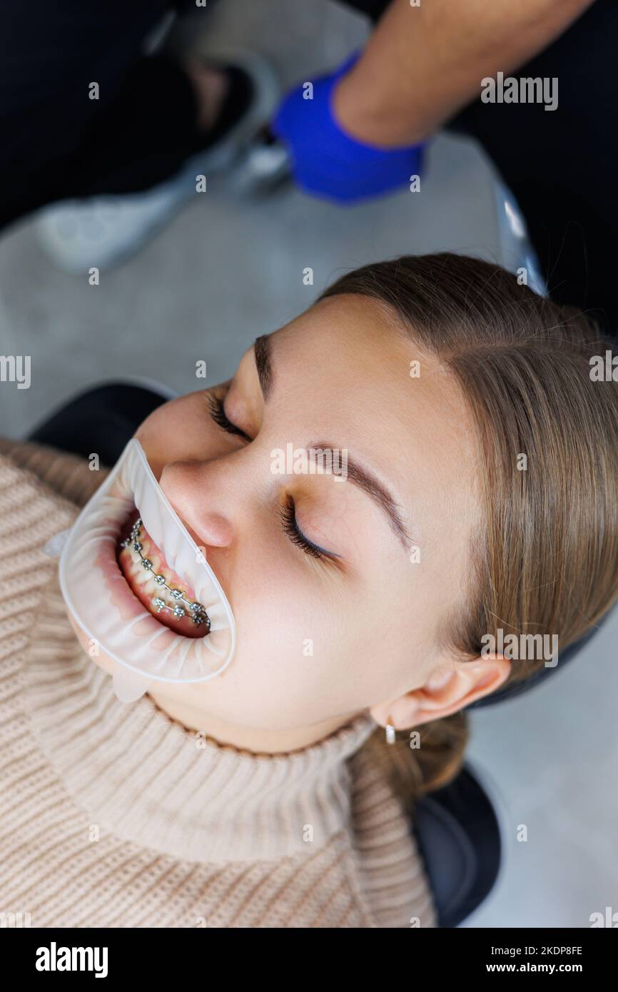 Woman teeth with braces on white teeth. An orthodontist uses dental ...