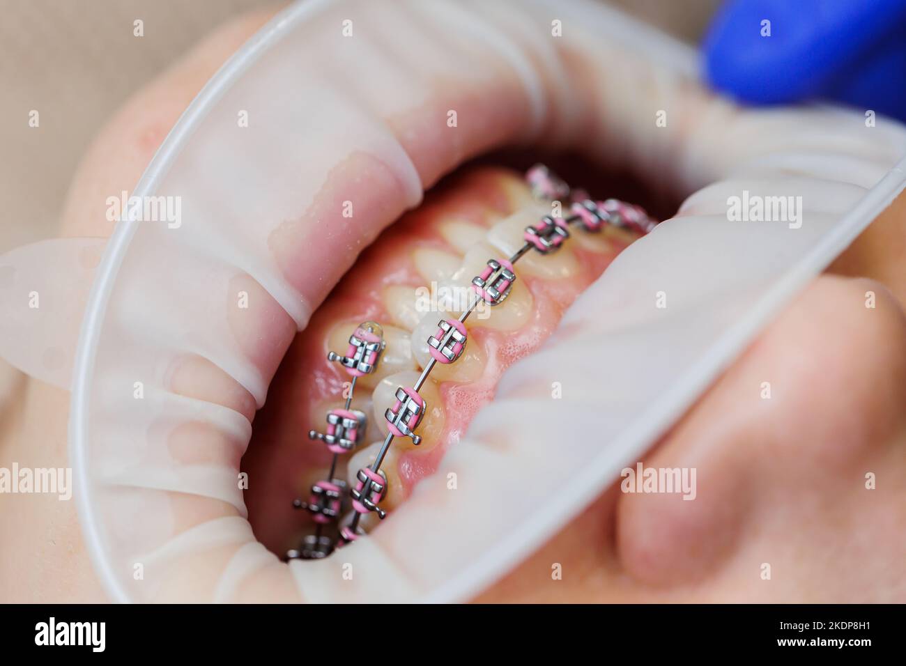 Close-up of mouth and teeth with metal braces. Orthodontic dental treatment Stock Photo - Alamy