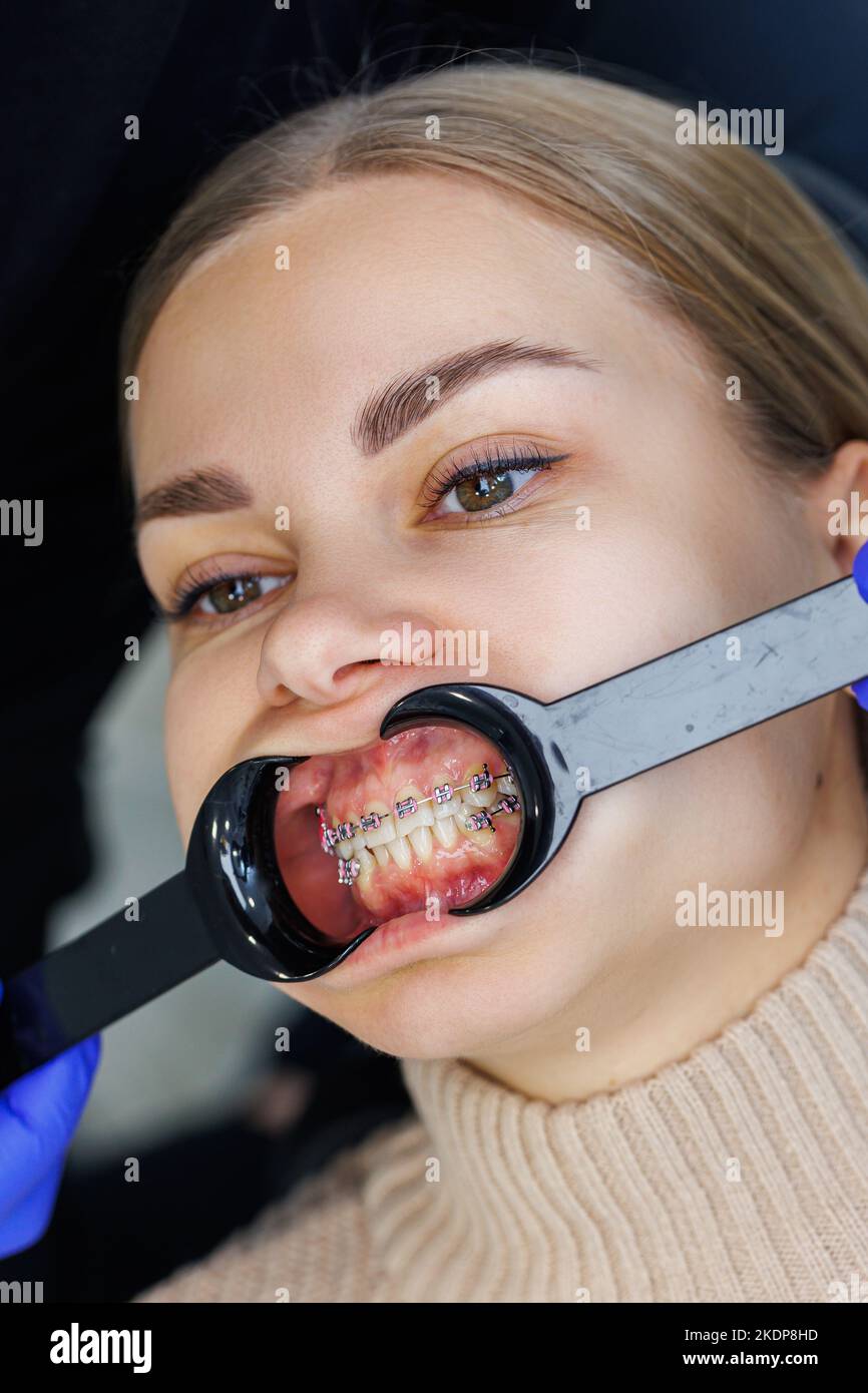 Close-up of mouth and teeth with metal braces. Orthodontic dental ...