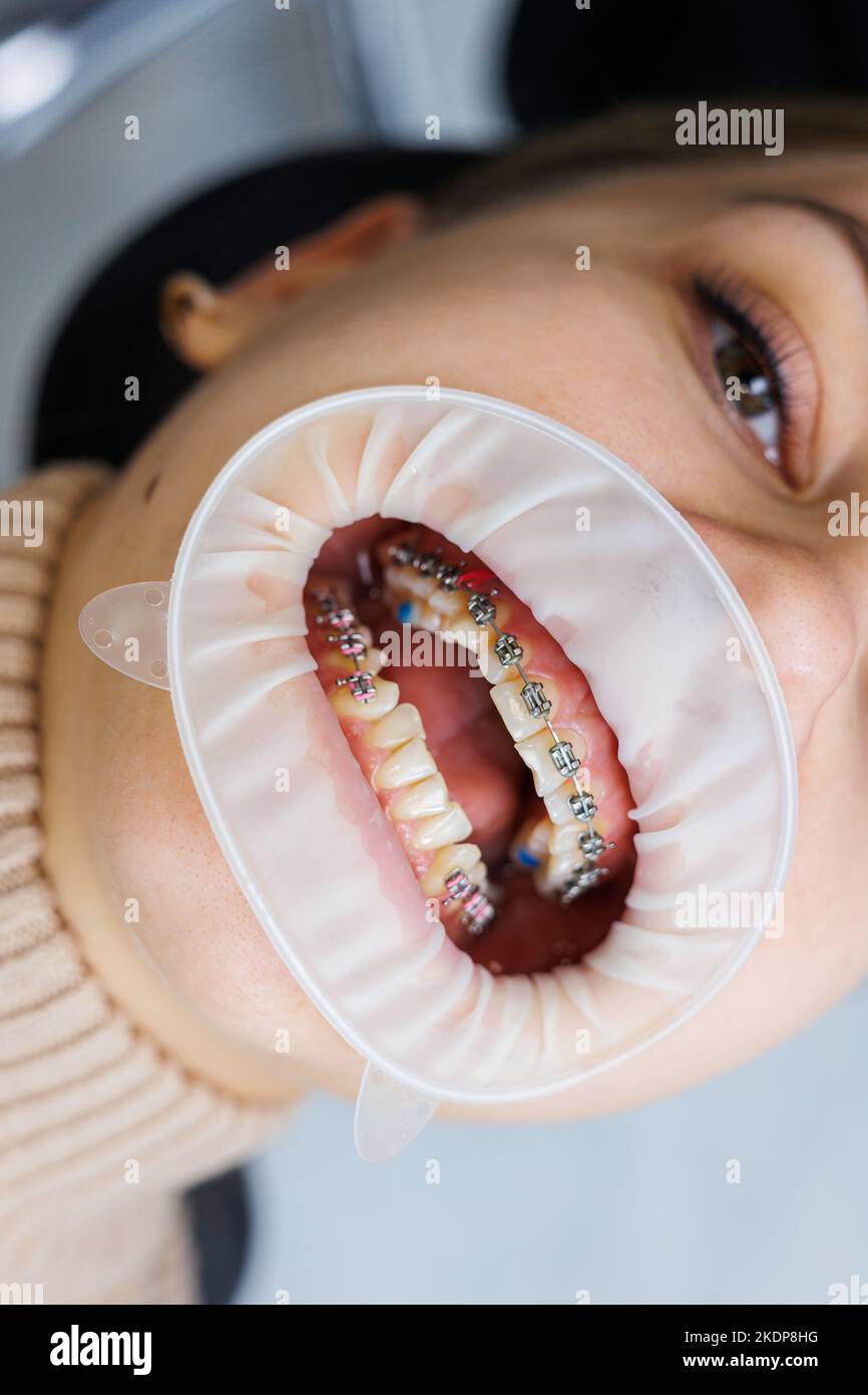 Teen girl with braces closeup hi-res stock photography and images - Alamy