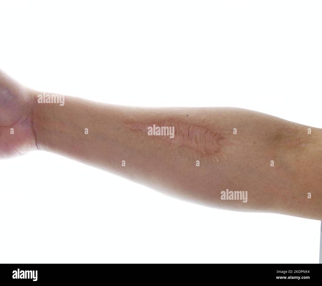 surgical intervention forearm scar Stock Photo - Alamy surgical intervention forearm scar Stock Photo - Alamy