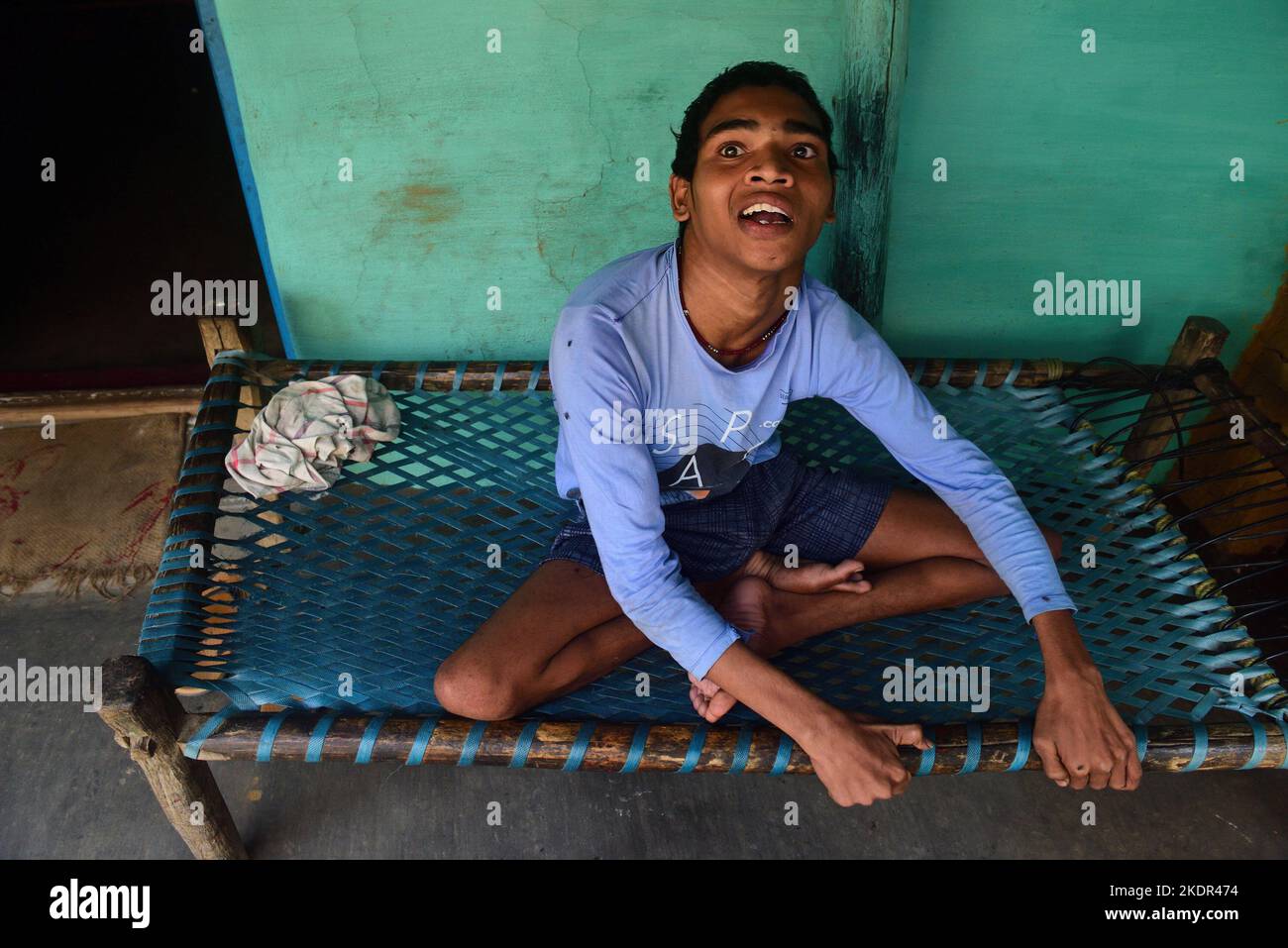 Sanjay Gope age 18 years from Bango in jadugoda suffers from muscular ...