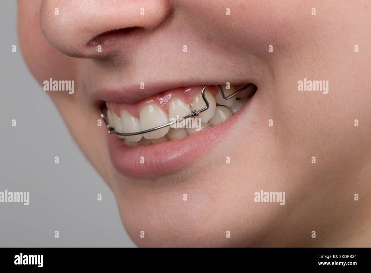 young girl is smiling and shows her removable dental brace Stock Photo ...