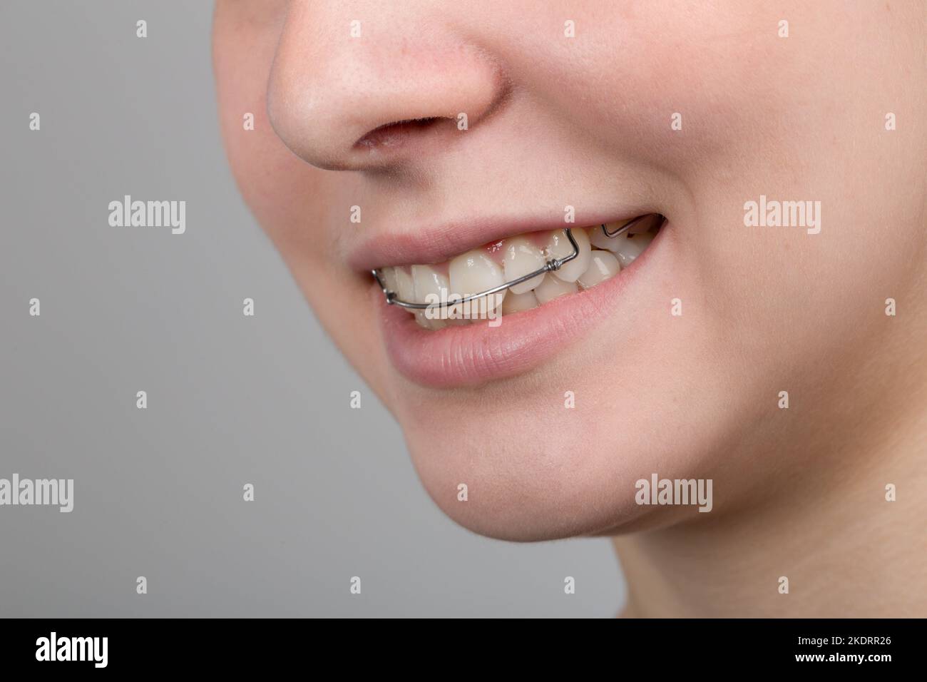 young girl is smiling and shows her removable dental brace Stock Photo ...