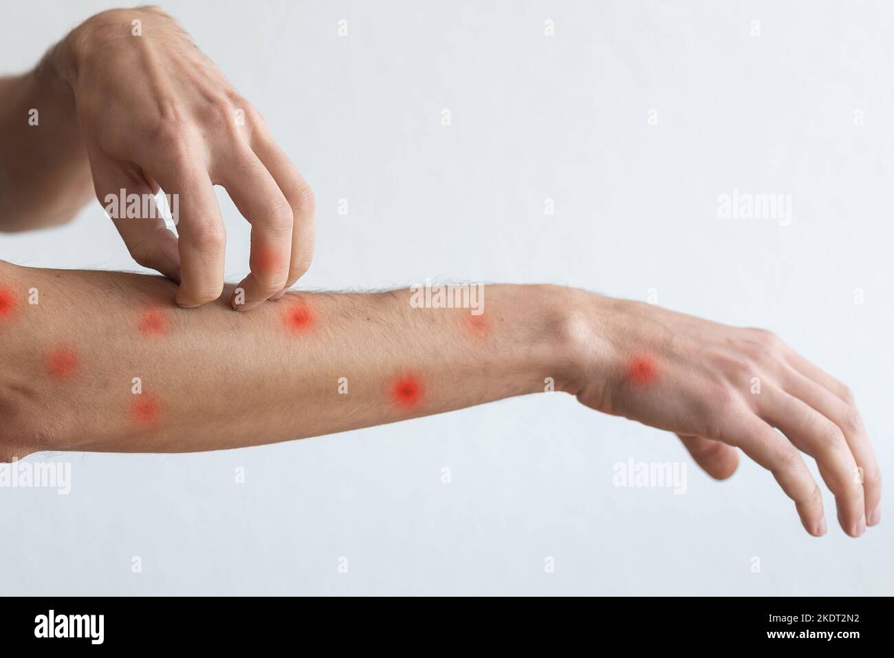 ill allergic rash dermatitis eczema skin of patient Stock Photo - Alamy