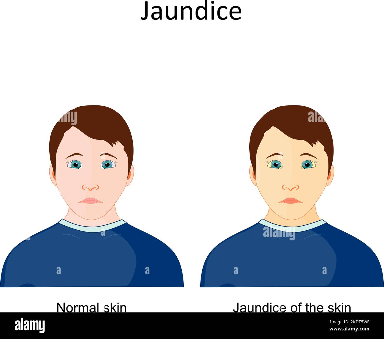 Jaundice. Signs and symptoms of disease. comparison and differences ... Jaundice. Signs and symptoms of disease. comparison and differences ...