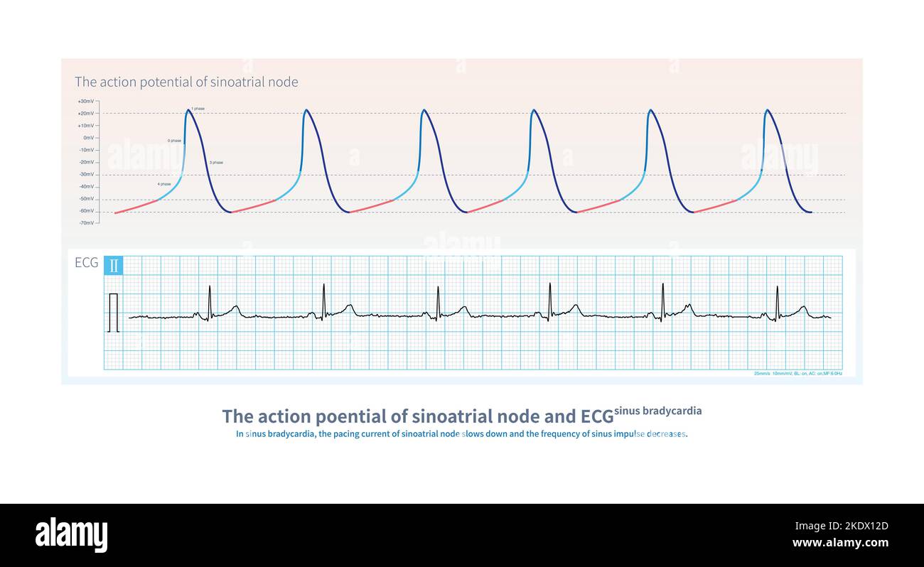 Action potential of sinoatrial node and ECG, illustration Stock Photo ...