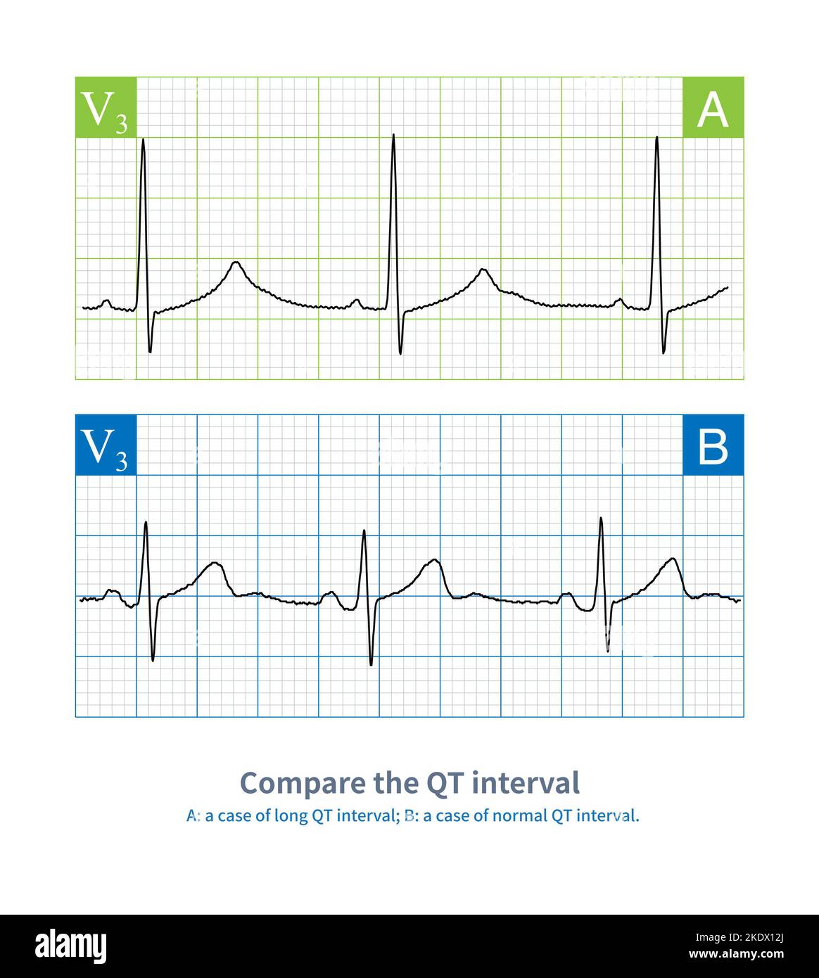 Long and normal QT intervals, illustration Stock Photo - Alamy