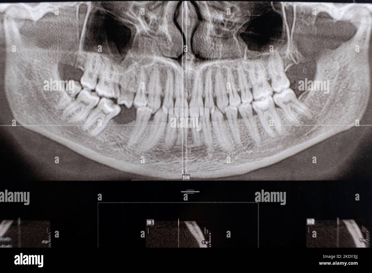 CT scan of a patient with missing chewing tooth and malocclusion Stock ...