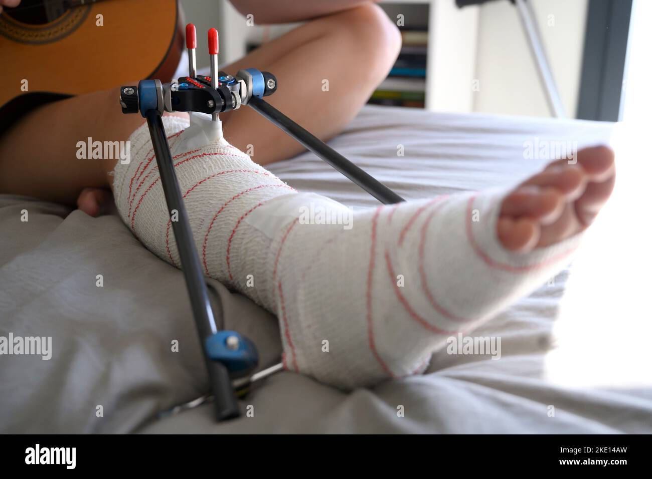 Woman with External fixation right tibial fracture Stock Photo - Alamy