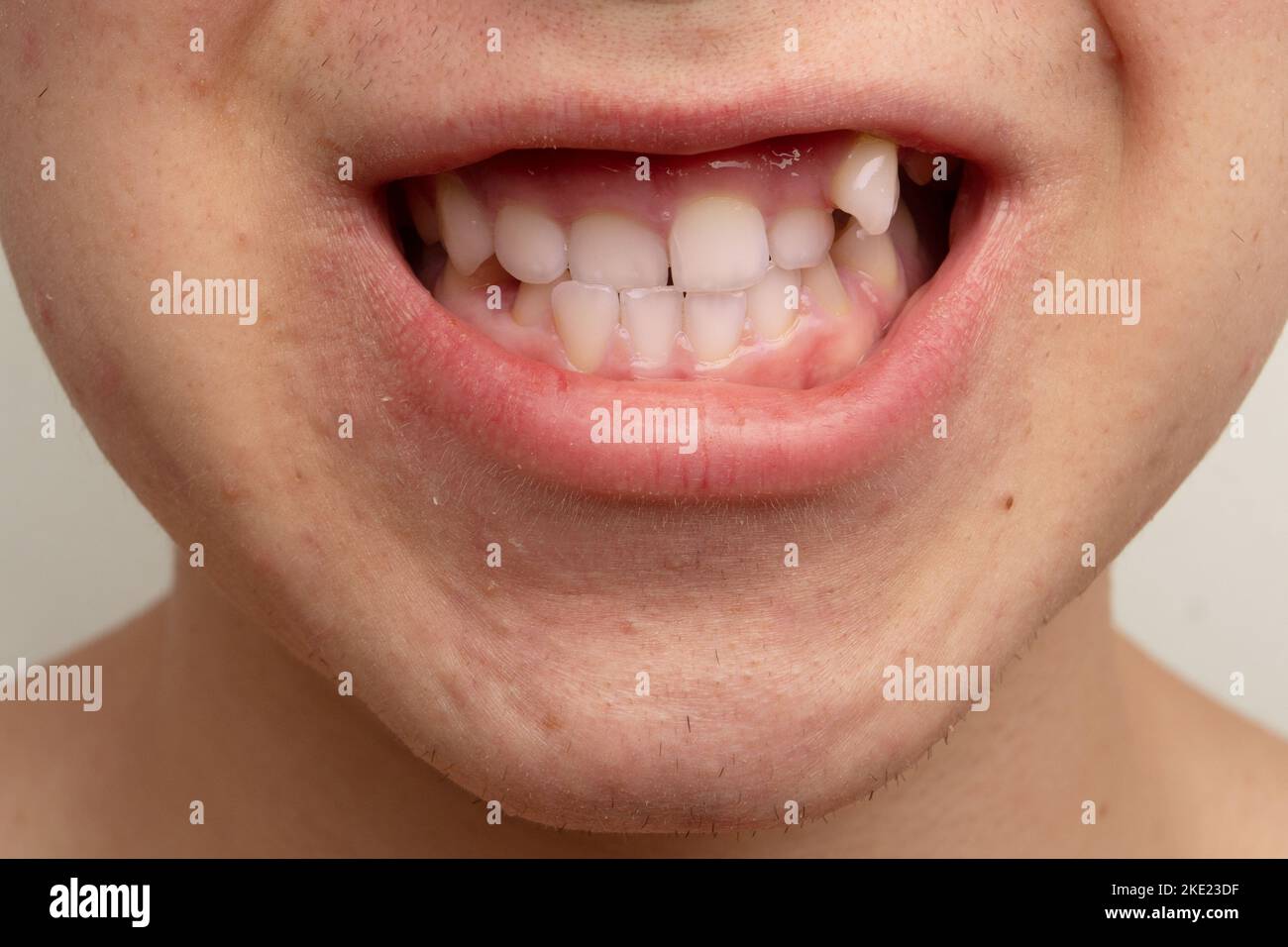 Smile bad teeth hi-res stock photography and images - Alamy