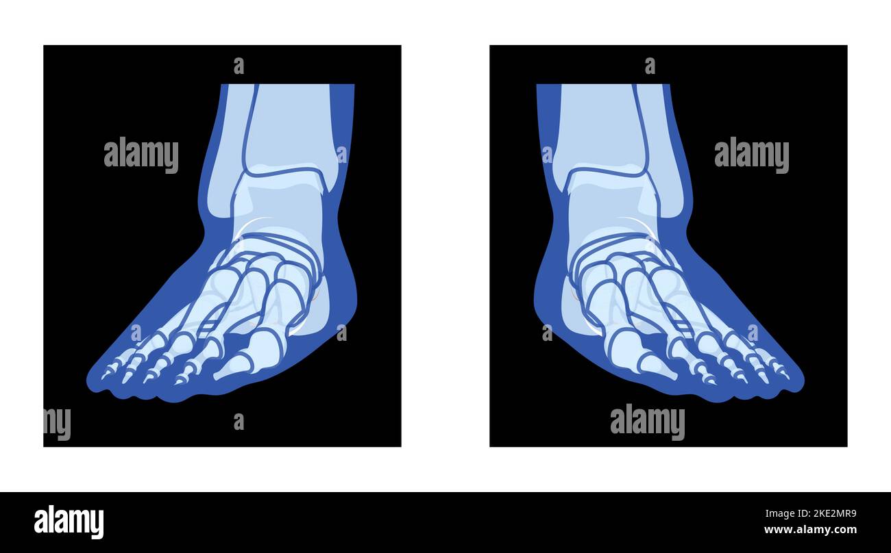 X-Ray Foot Legs Skeleton Human body Bones - malleolus, Phalanges adult ...