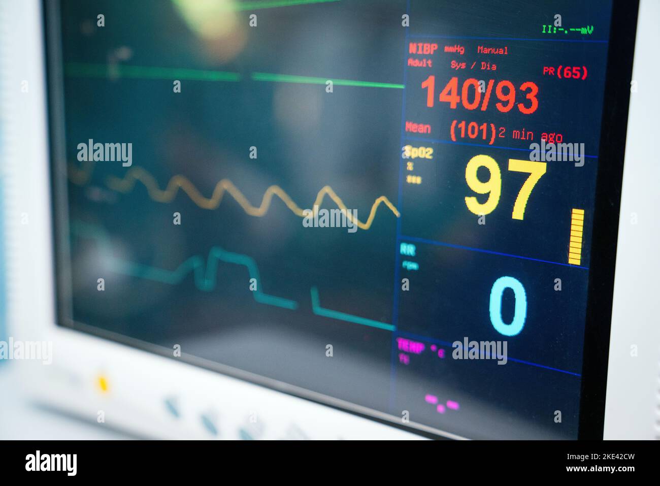 Ekg machine in hospital emergency room used for heart attack diagnosis ...