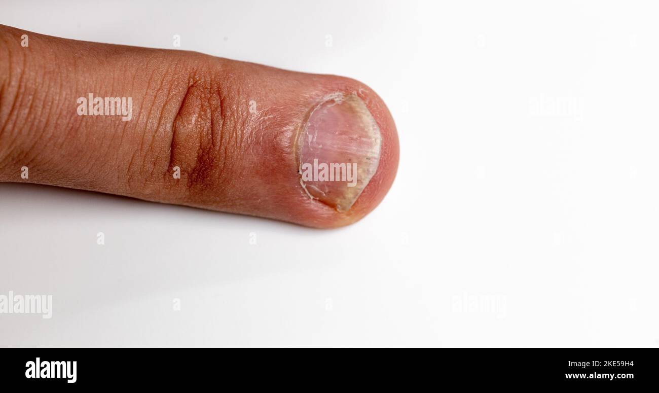 Onychodystrophy hi-res stock photography and images - Alamy