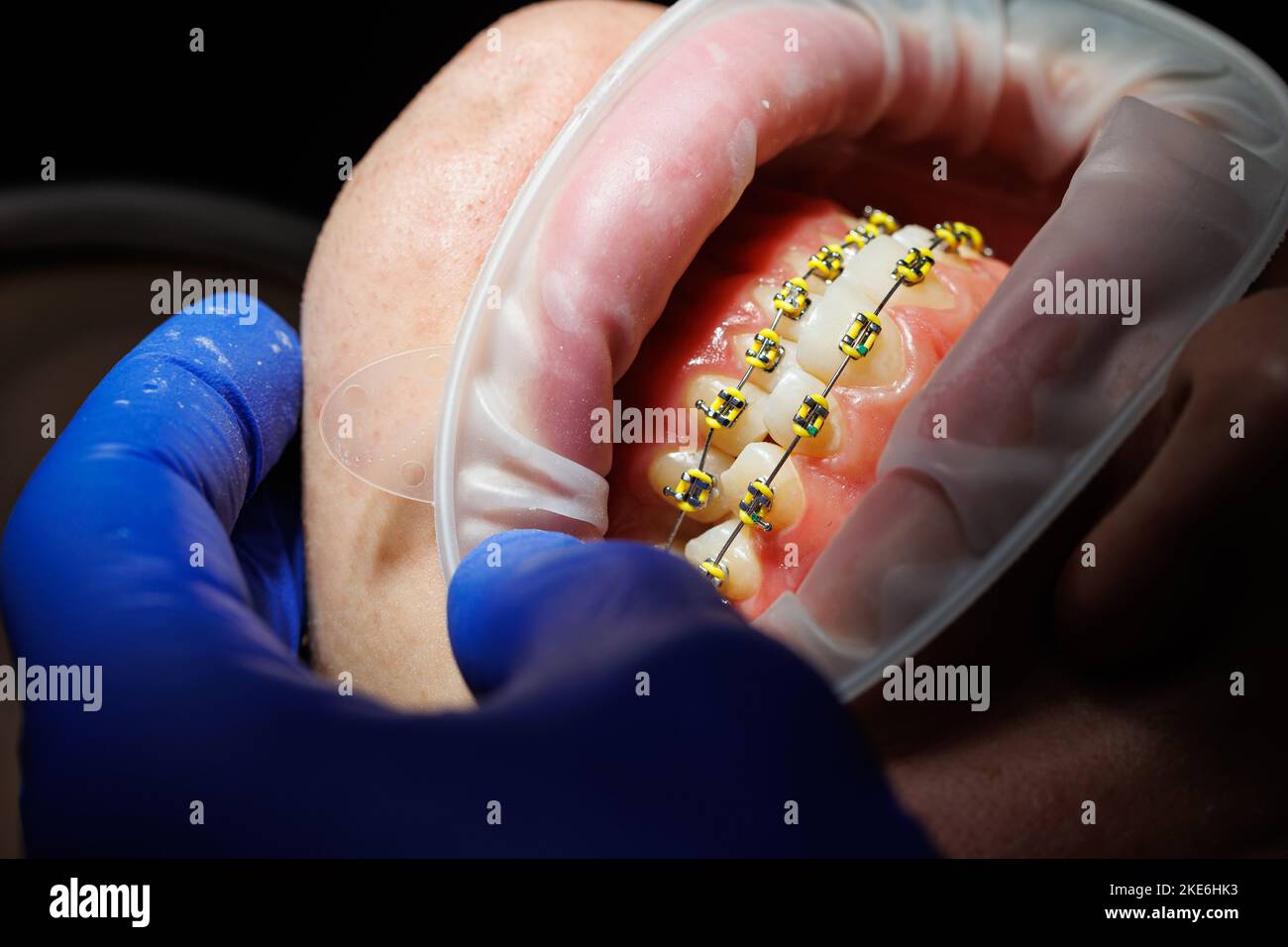 Extender for teeth. Teeth of a woman with braces at a dentist ...