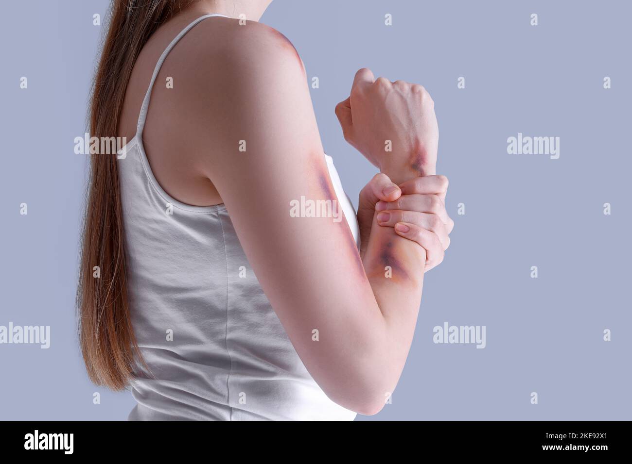 Bruised arm hi-res stock photography and images - Alamy