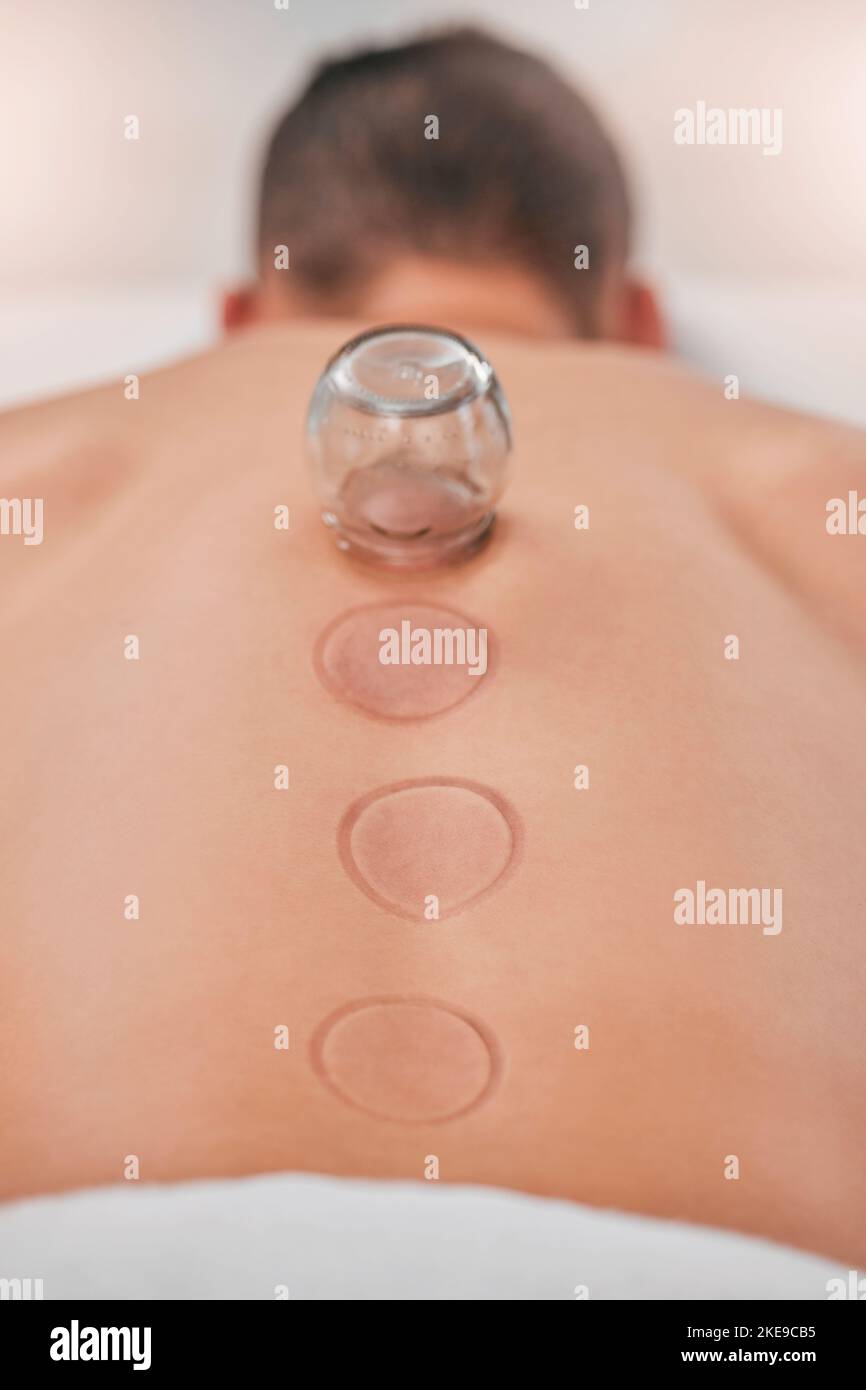 Wellness, man and cupping massage at spa for relief in stress ...