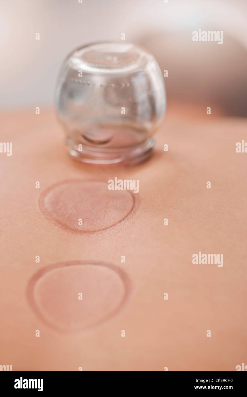 Spa, wellness and person with suction treatment on back for pain ...