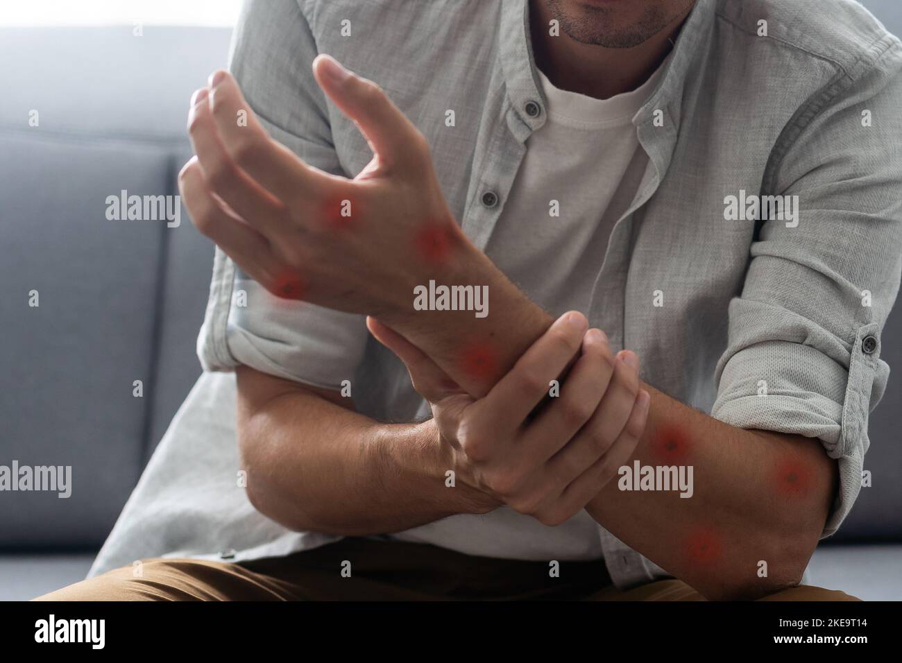 ill allergic rash dermatitis eczema skin of patient Stock Photo - Alamy