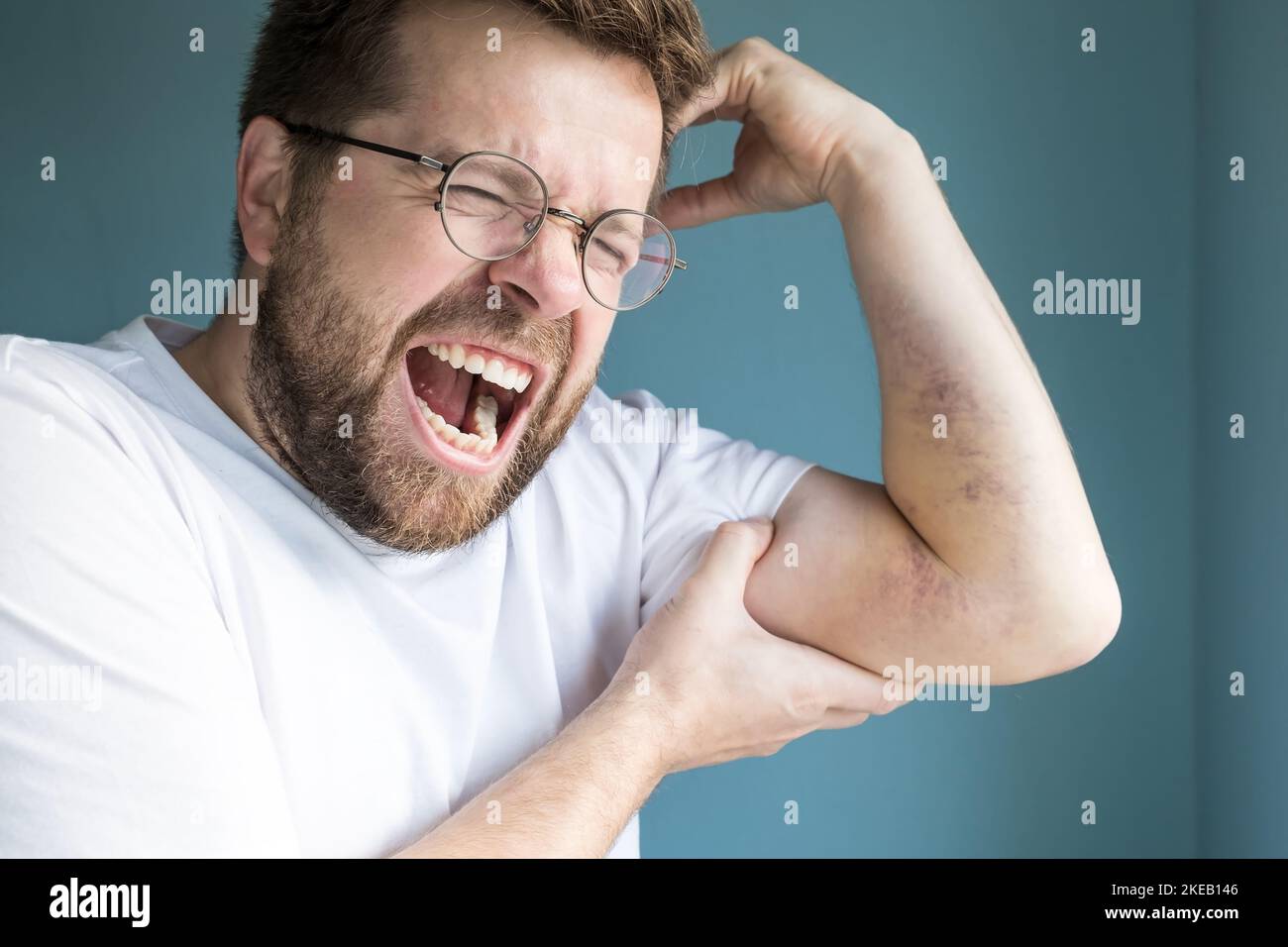 Man with a large bruise on arm, he got injured and is in pain Stock ...