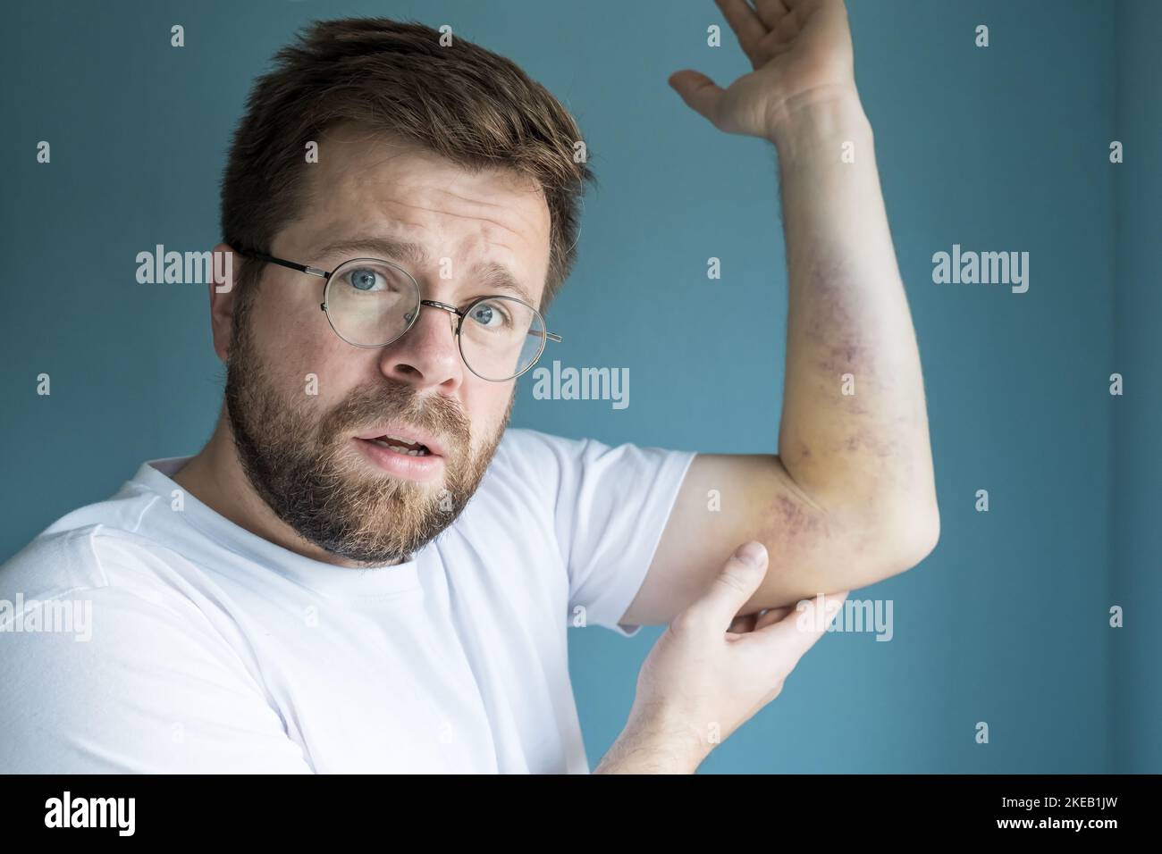 Man shows a bruise on his arm caused by an injury Stock Photo - Alamy