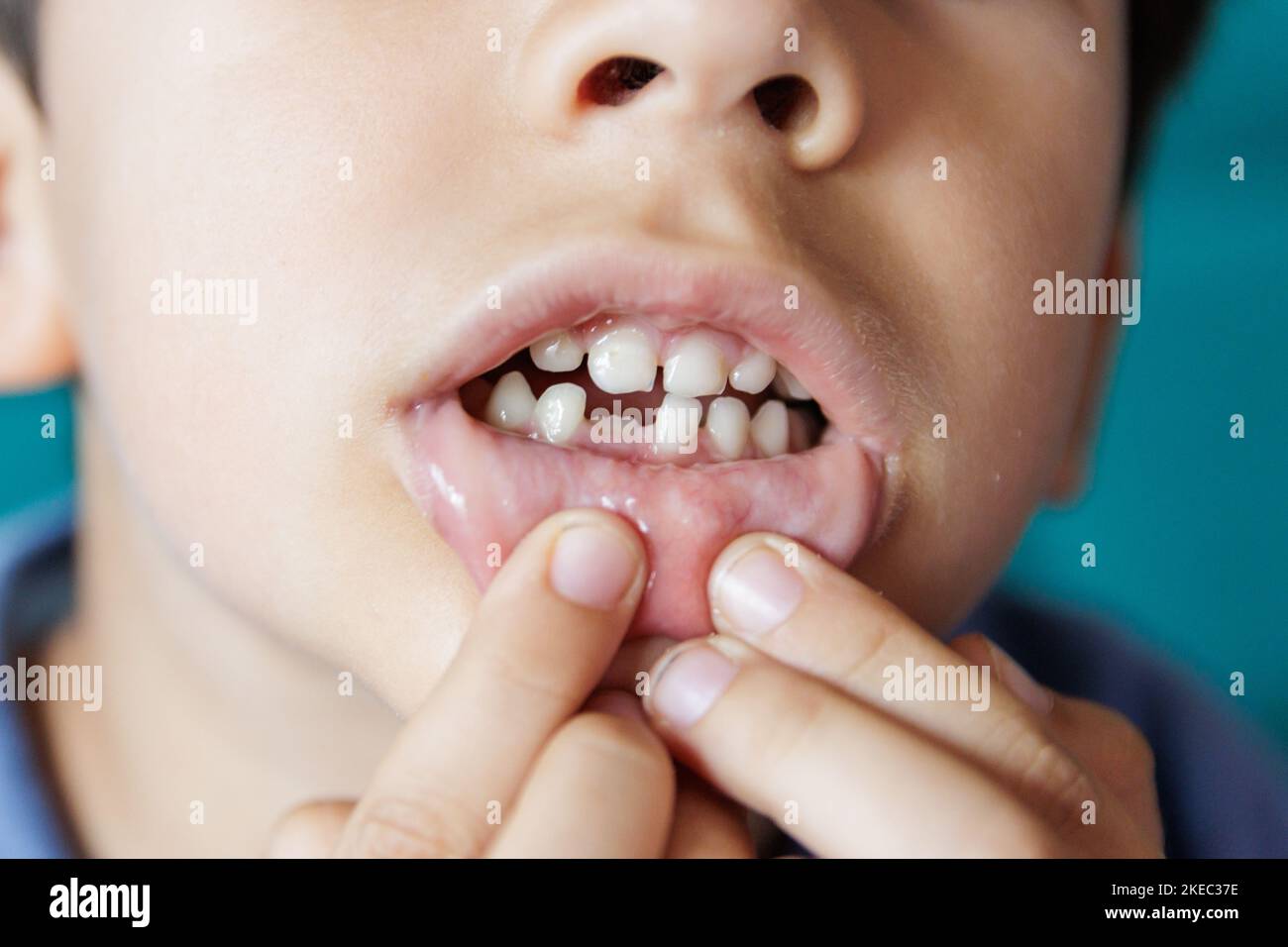Child's mouth with dent due to fallen milk tooth Stock Photo - Alamy
