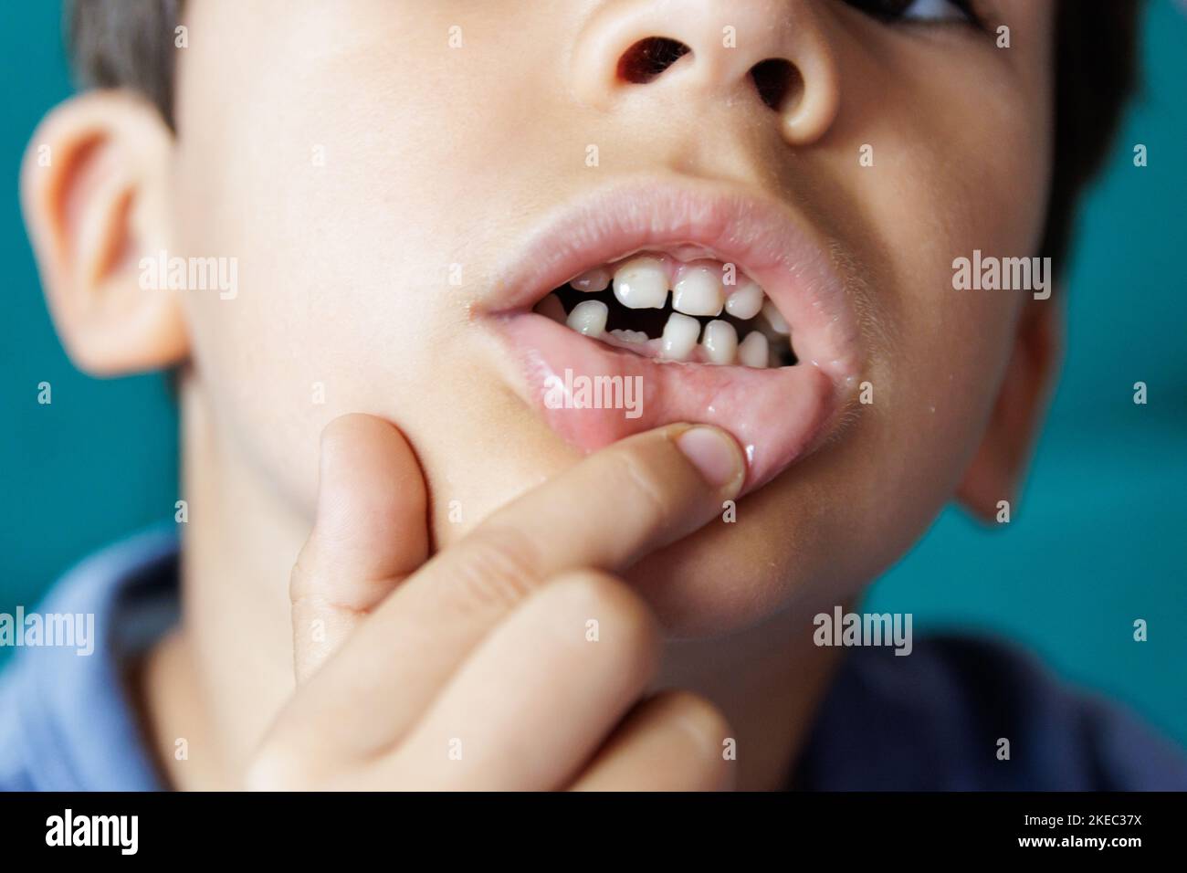 Child's mouth with dent due to fallen milk tooth Stock Photo - Alamy