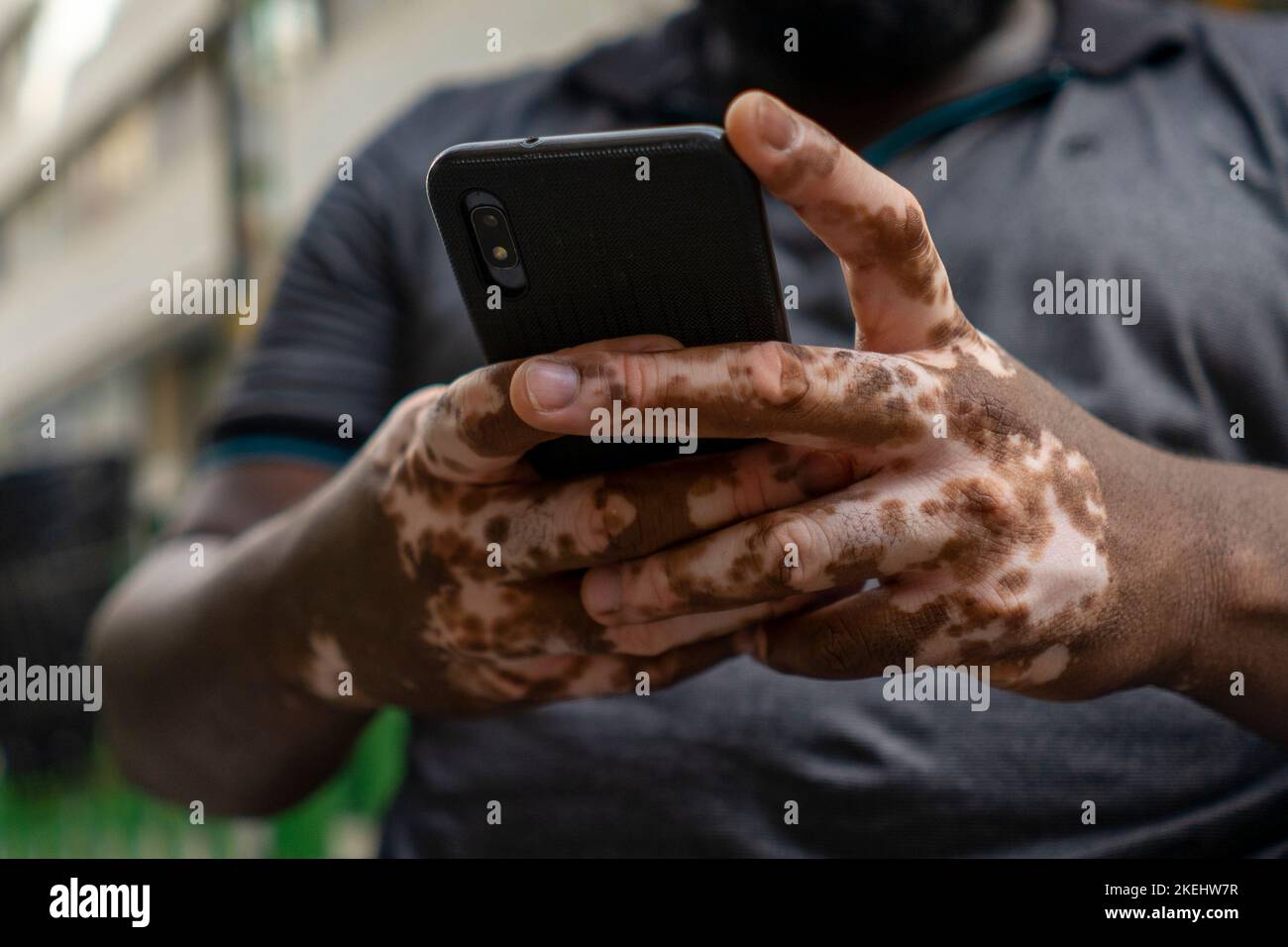 African vitiligo face hi-res stock photography and images - Alamy