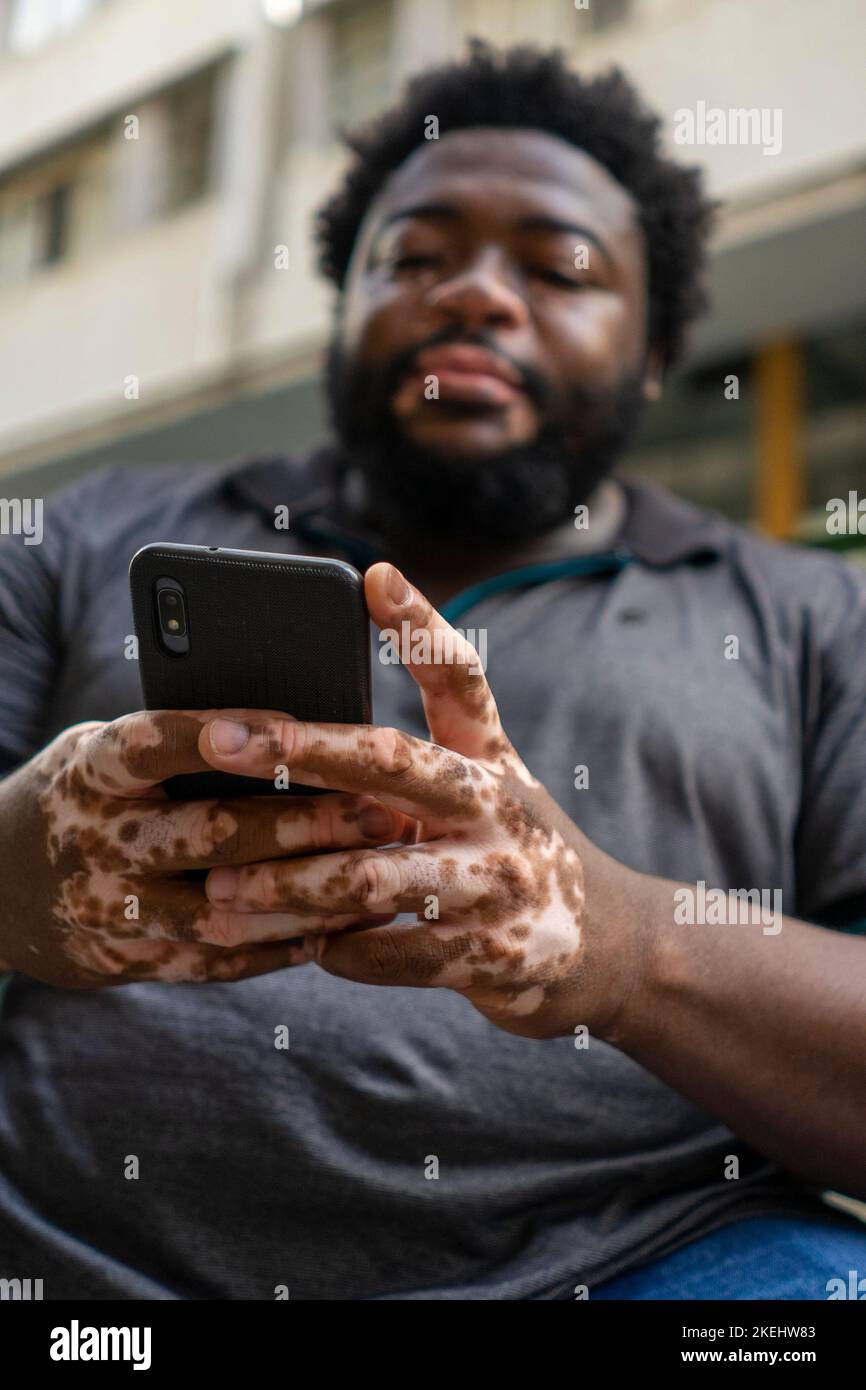 African vitiligo face hi-res stock photography and images - Alamy