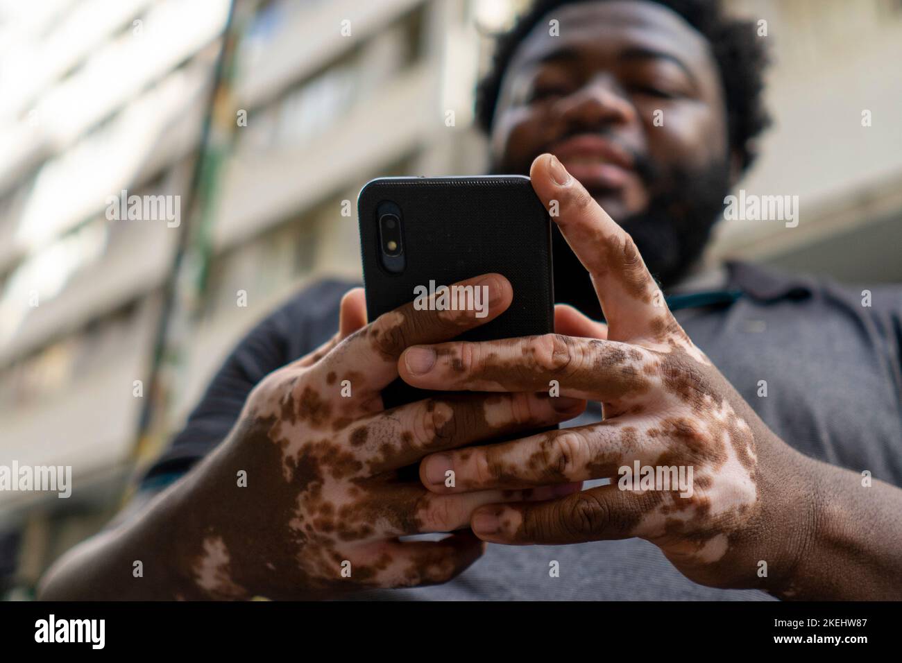 African vitiligo face hi-res stock photography and images - Alamy