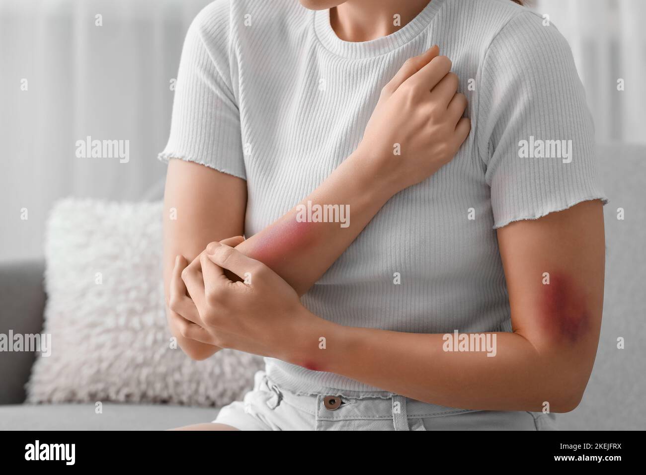 Bruises on arms hi-res stock photography and images - Alamy
