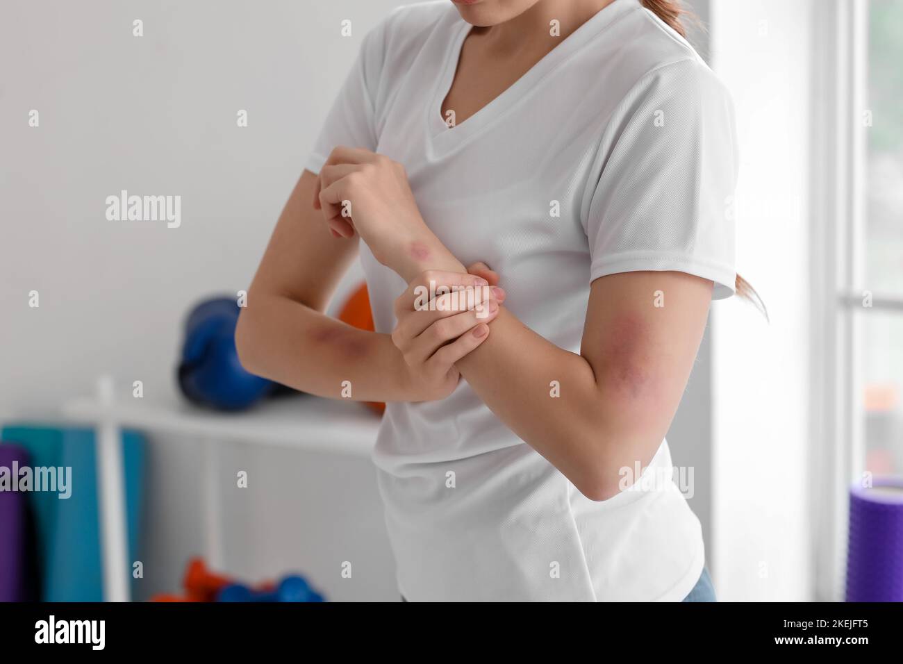 Sporty young woman with bruised arm in gym Stock Photo - Alamy