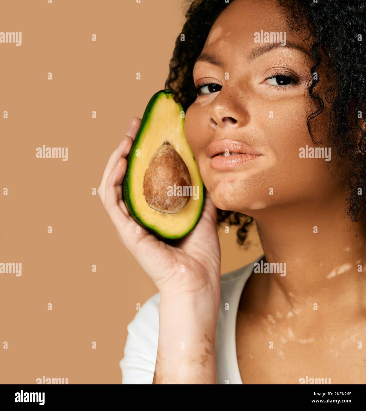 Cosmetics with avocado for pigmented skin. African woman with vitiligo ...